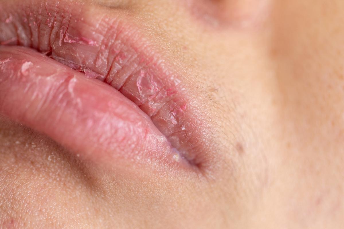 Cómo curar los labios quemados por el sol - ¡Descubre los síntomas y ...