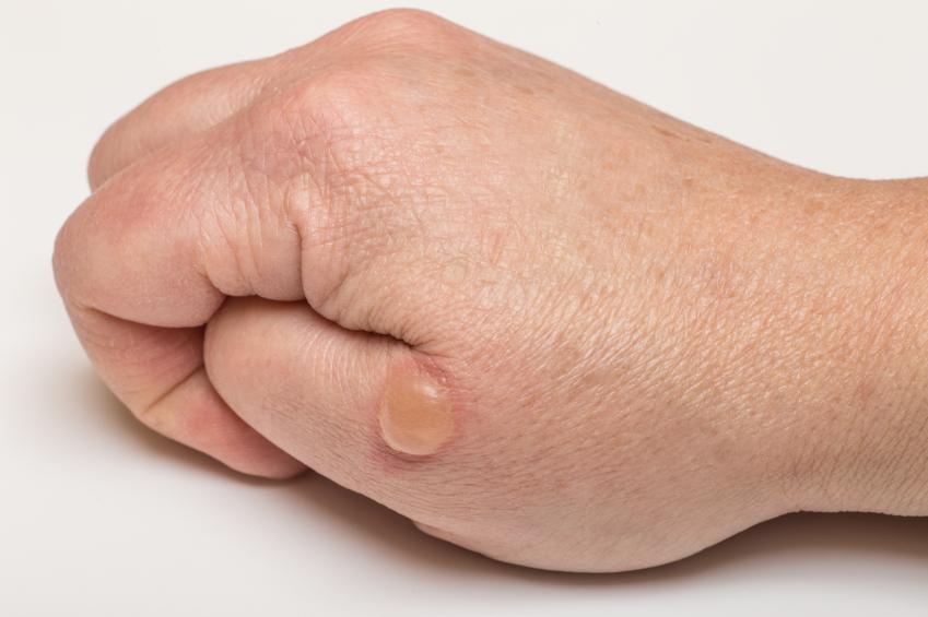 Cómo curar una ampolla por quemadura - 8 pasos