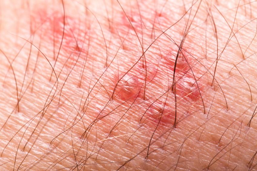 Cómo curar el herpes - 5 pasos