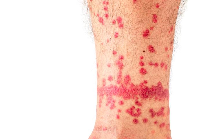 Cómo Eliminar Pulgas en Humanos - ¡Los trucos más efectivos!