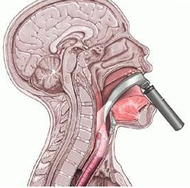 Cuáles son las complicaciones de la intubación gástrica