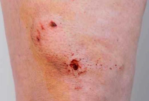 Cómo saber si una herida está infectada - 9 pasos