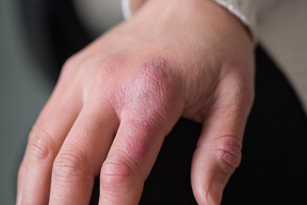 Sabañones en las manos: causas, cómo curarlos y cómo puedes evitarlos