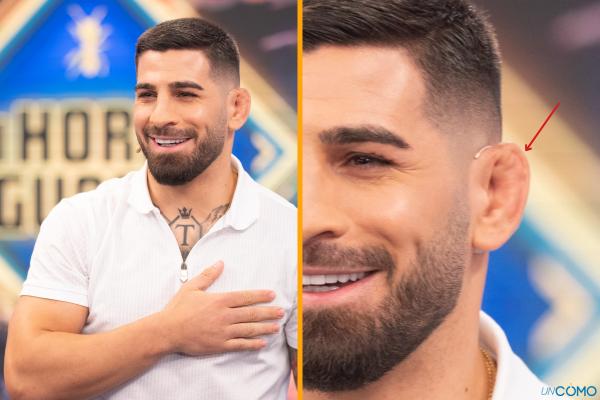 Orejas de coliflor o boxeador: qué son estas marcas, cómo aparecen y ...