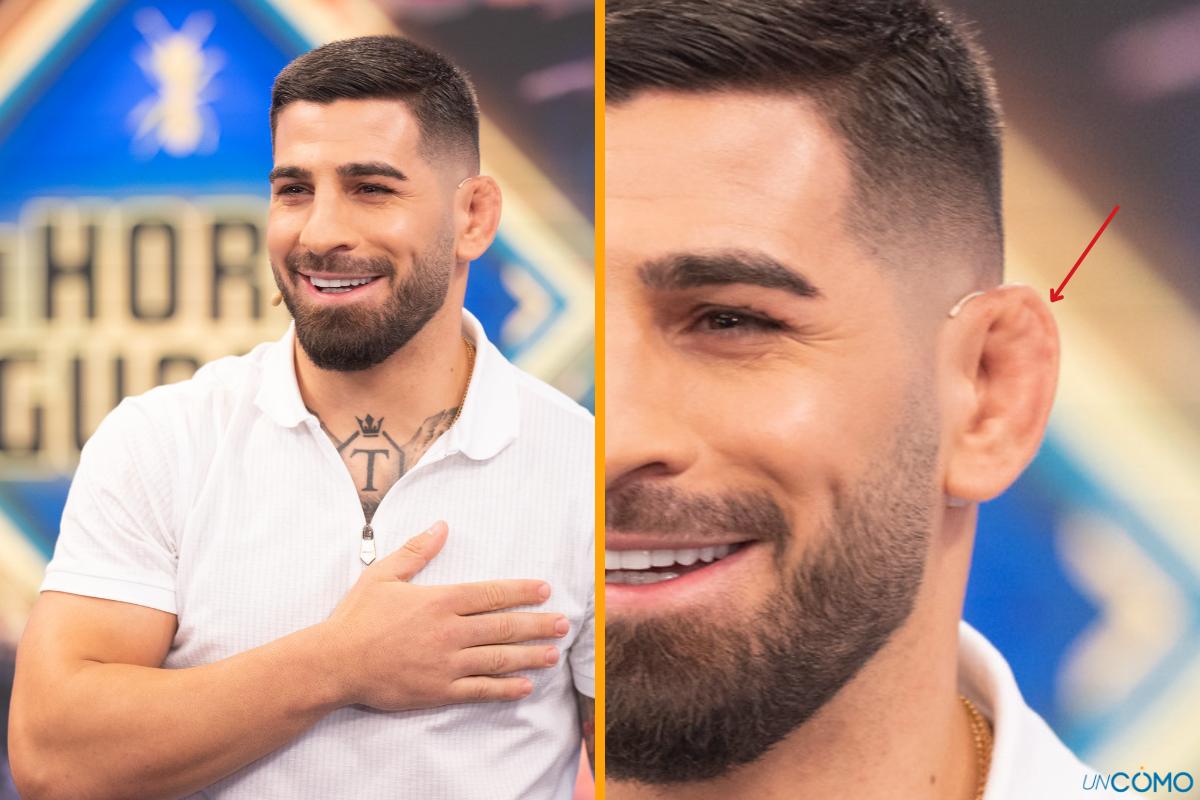 Orejas de coliflor o boxeador: qué son estas marcas, cómo aparecen y ...