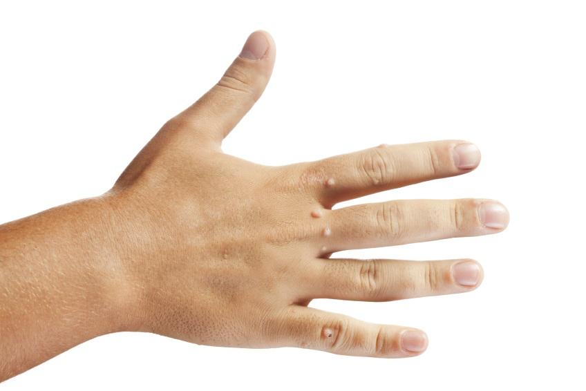 Cómo aplicar nitrato de plata en verrugas