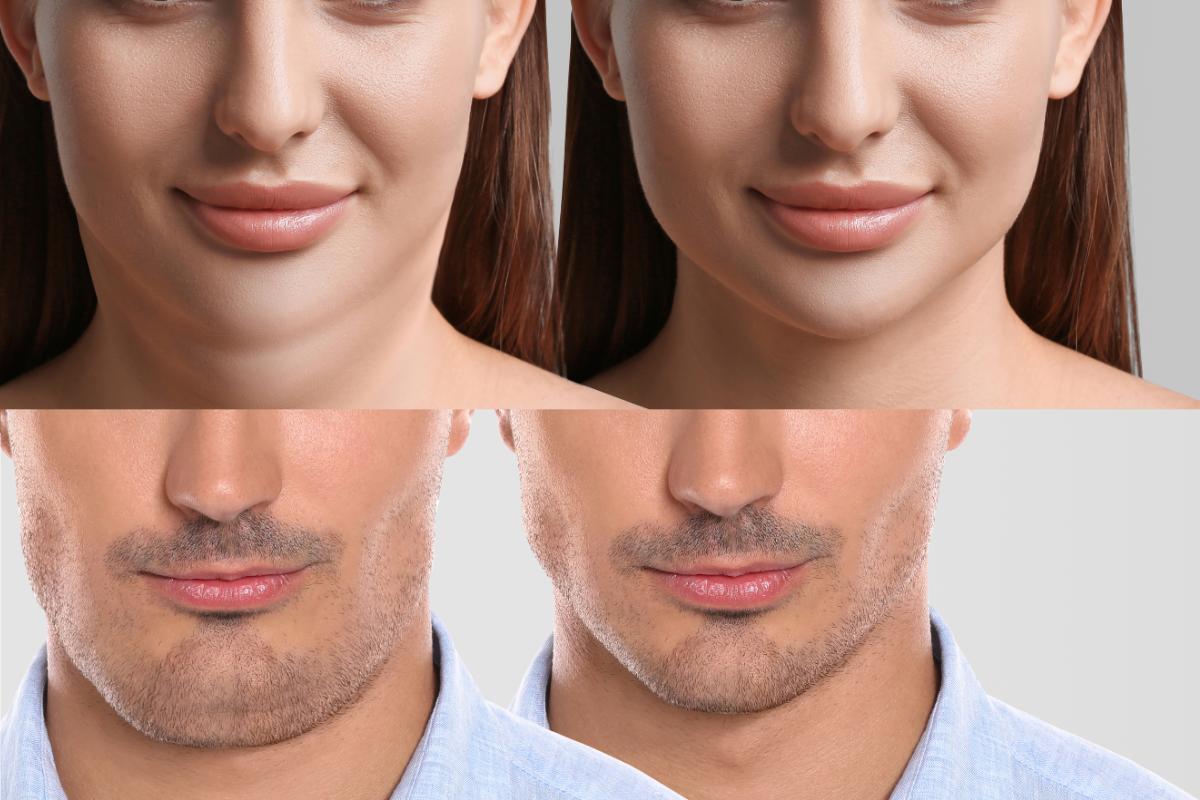 ¿Qué es el mewing? ¿Es peligroso hacerlo? - Conoce cómo se hace y sus ...