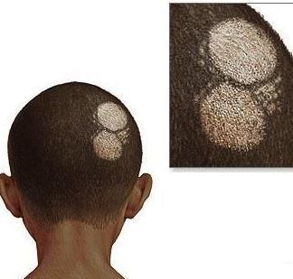 Cómo diagnosticar la tiña - 3 pasos