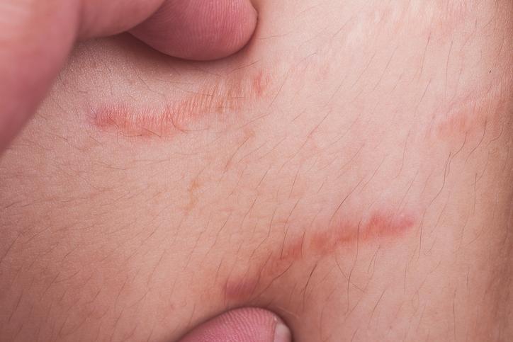 Estrías en hombres: por qué salen y cómo quitarlas