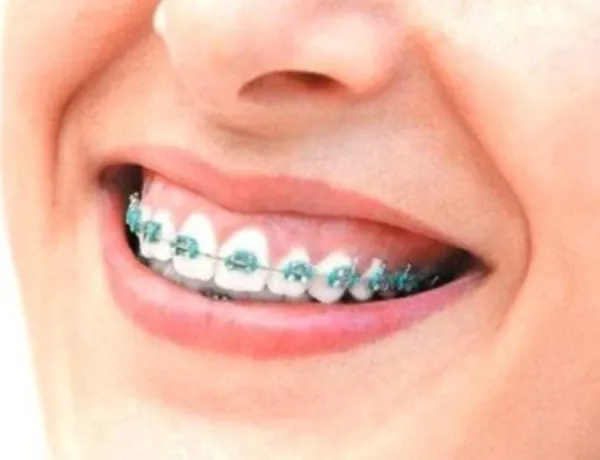 como calmar dolor de brackets