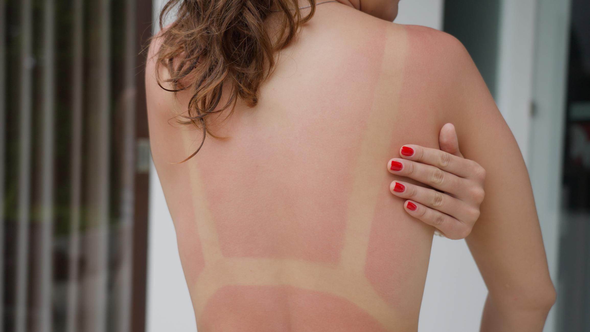 Cómo aclarar la piel quemada por el sol - Remedios caseros para deshacerte del rojo de la piel