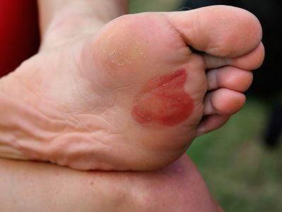 Cómo curar una quemadura por rozadura - 5 pasos