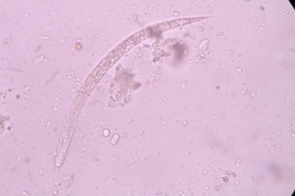 Cuáles son los síntomas de las lombrices intestinales