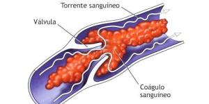Cómo tratar la flebitis - tratamiento médico y natural