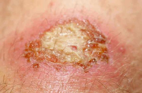 Cómo quitar la marca de una costra