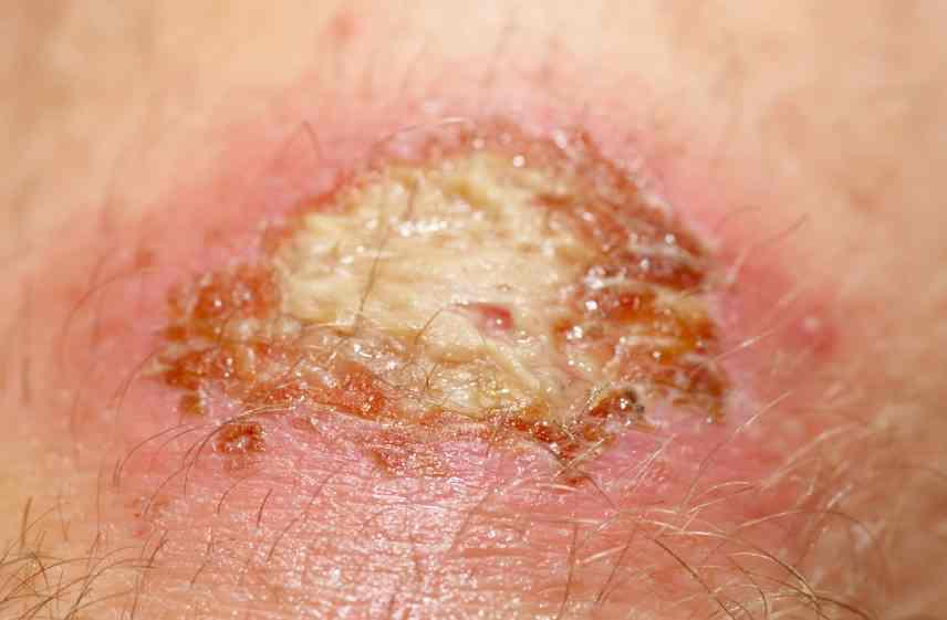 Cómo quitar la marca de una costra