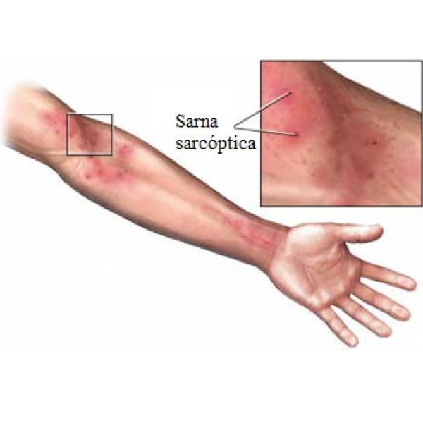 Qu Es La Sarna O Escabiosis Sntomas De La Sarna Sarna O Escabiosis