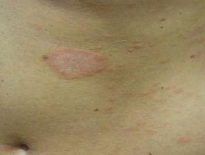 Cómo tratar la pitiriasis rosada - 6 pasos