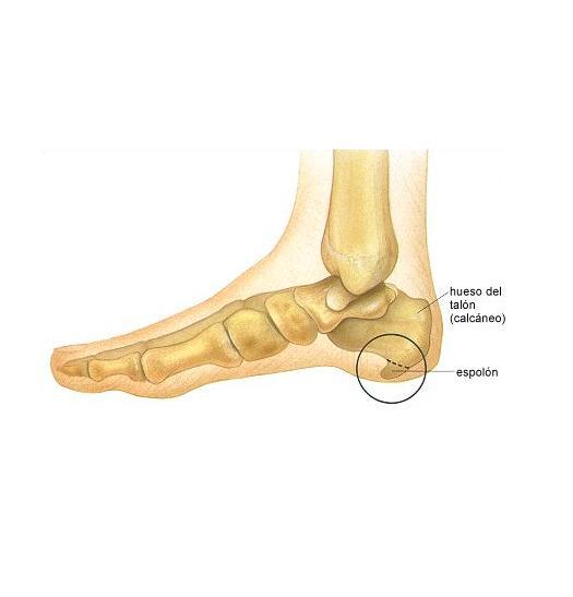 Cómo aliviar el dolor de un espolón - 9 pasos